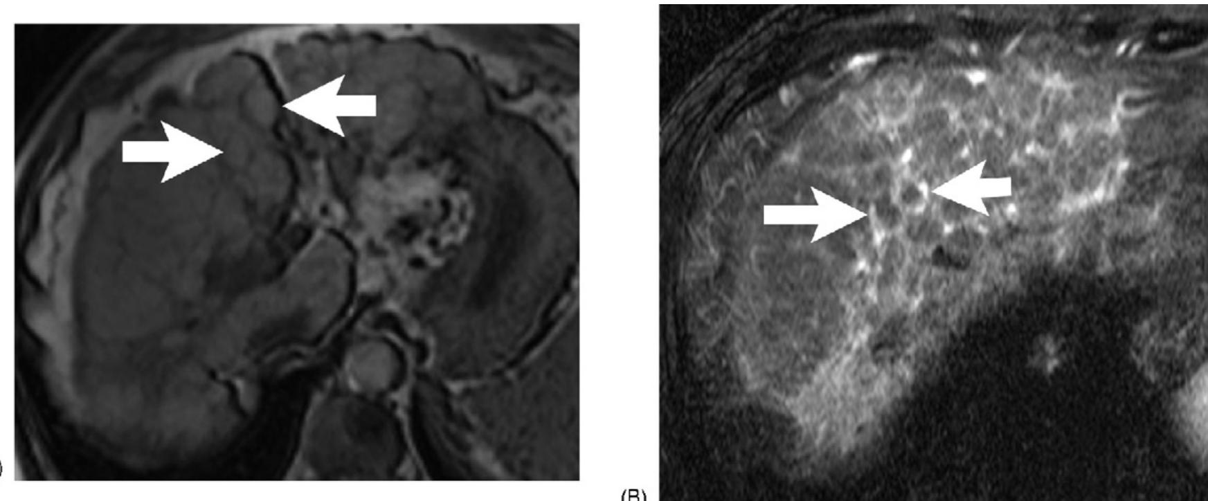 Cirrhosis and multiple regenerative nodules at mr imaging.