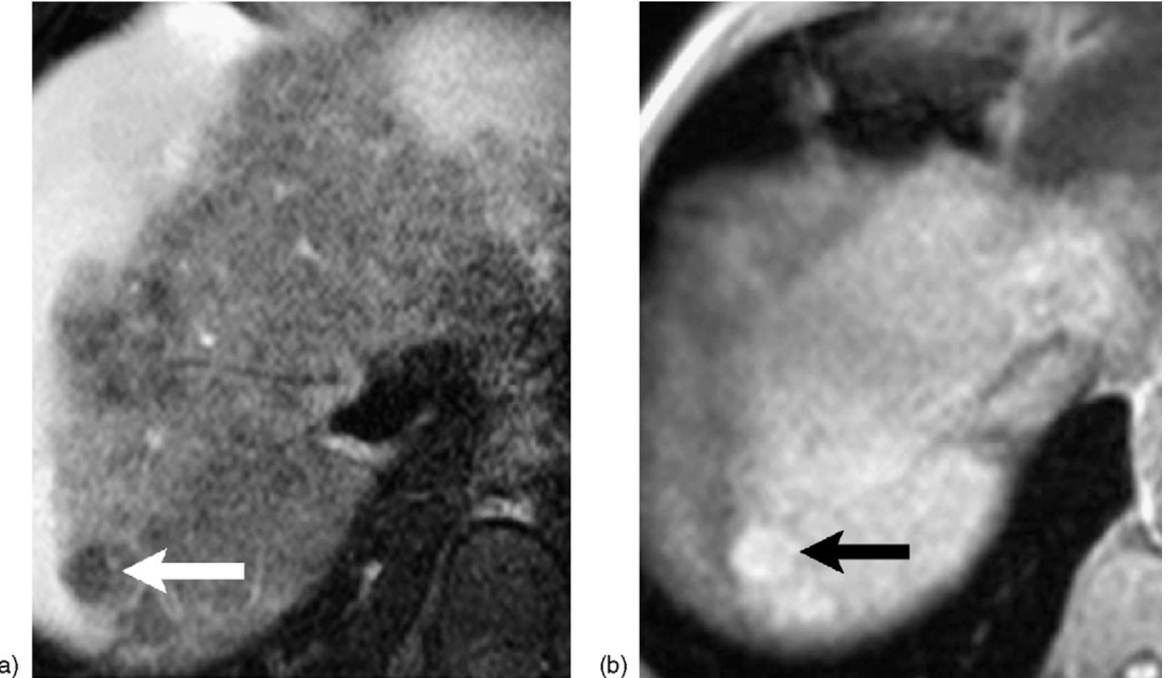Cirrhosis and dysplastic nodule at mr imaging. transverse