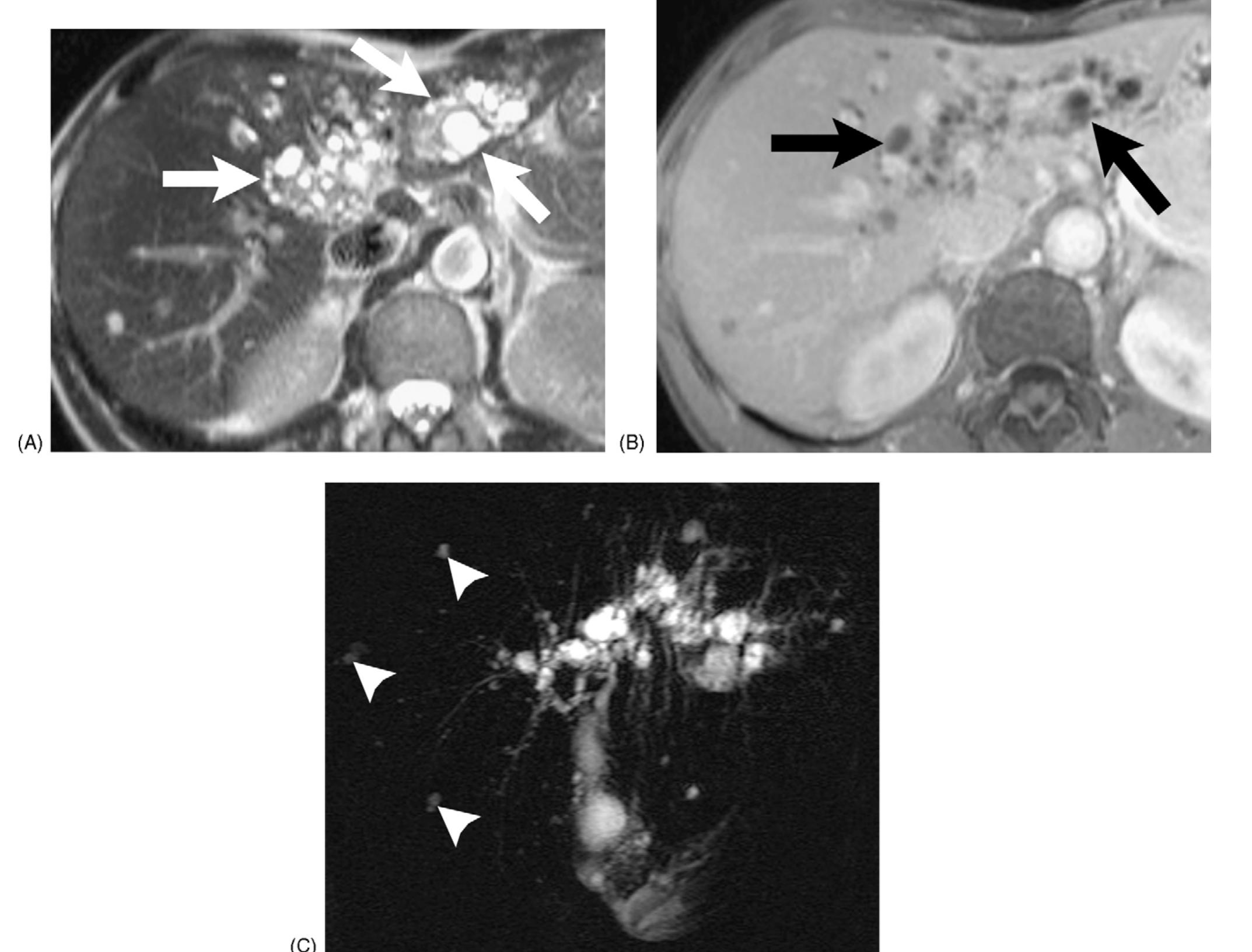 Cirrhosis and peribiliary cysts at mr imaging. transverse