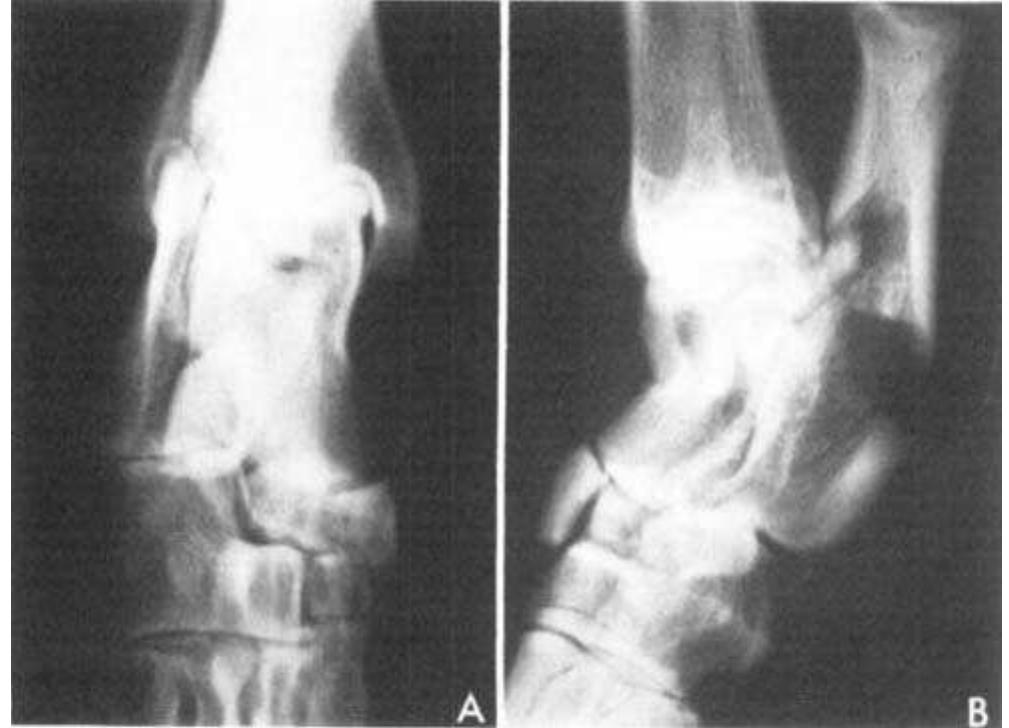 Dorsomedial slab fracture, lateral sagittal slab fracture