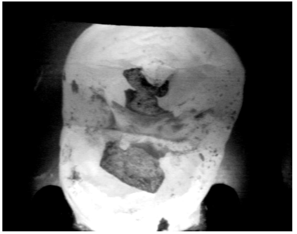 Difoti image of a tooth with an occlusal-surface caries.