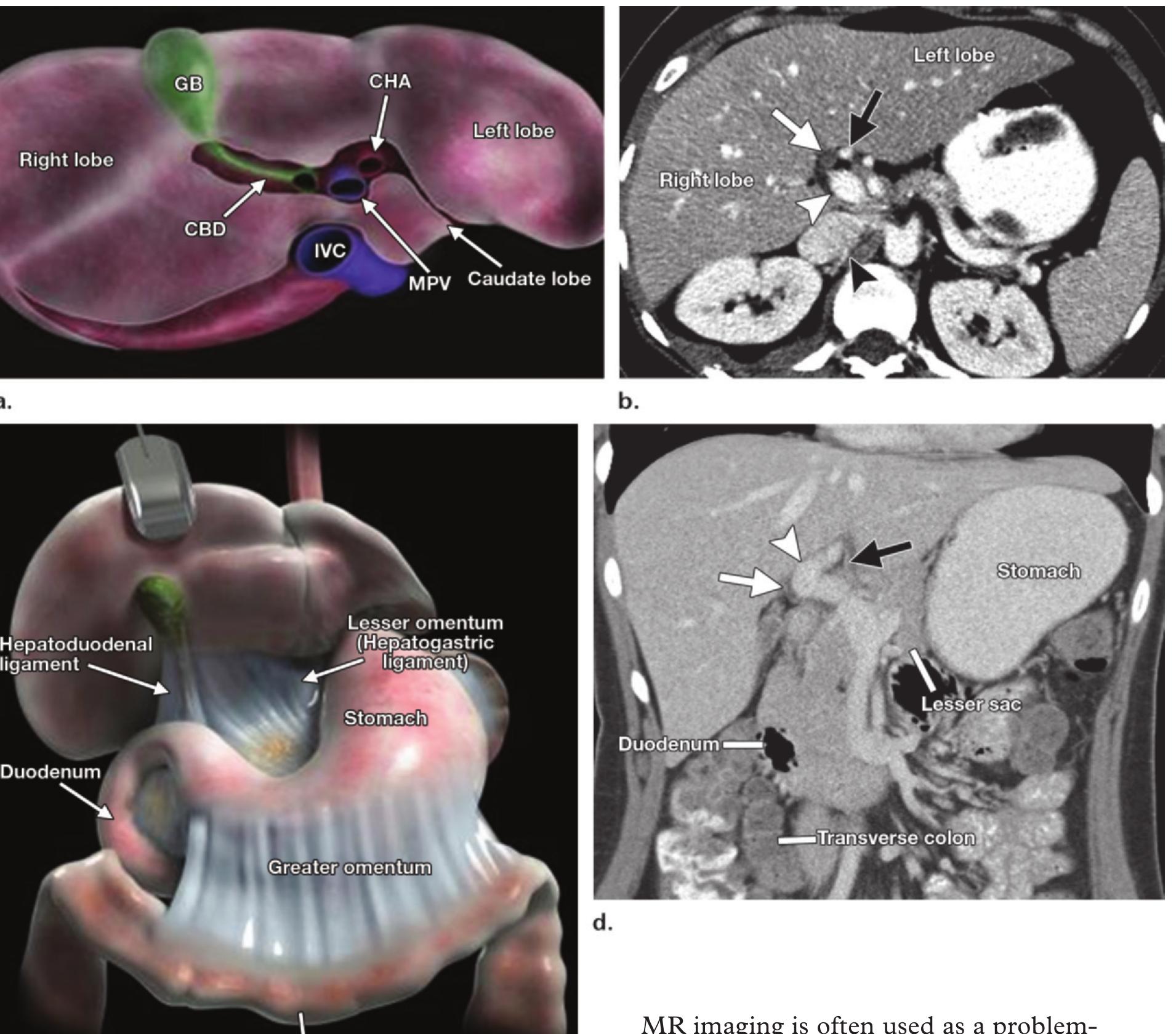 (PDF) Imaging of the Porta Hepatis: Spectrum of Disease