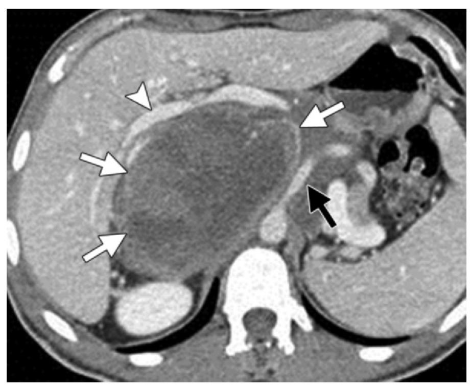 Figure 18 - Imaging of the Porta Hepatis: Spectrum of