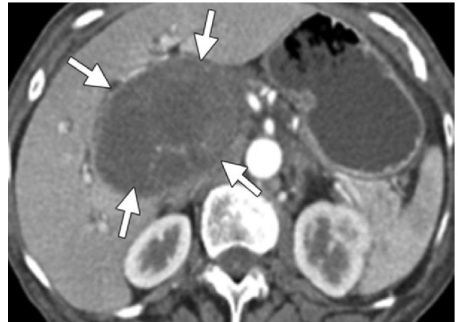 Figure 25 - Imaging of the Porta Hepatis: Spectrum of