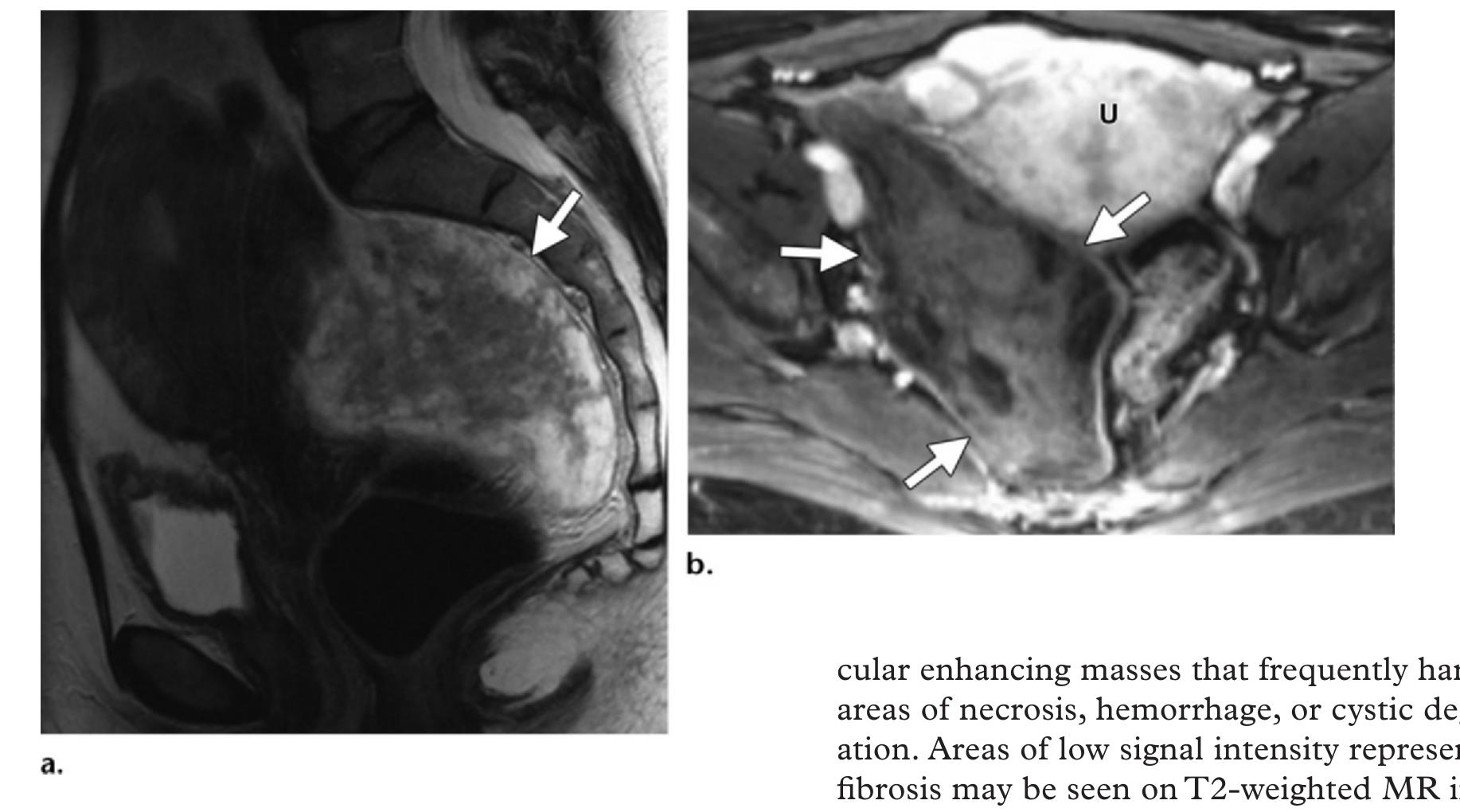 Gist. (a) sagittal t2-weighted mr image shows a large mass