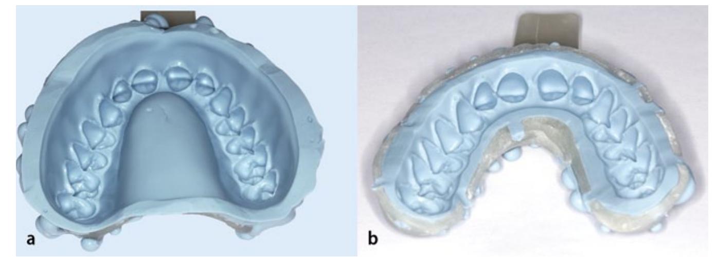 A alginate impression of the maxillary model with anterior