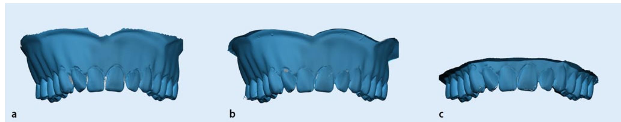 A maxilla with anterior crowding. a resin-model scan.