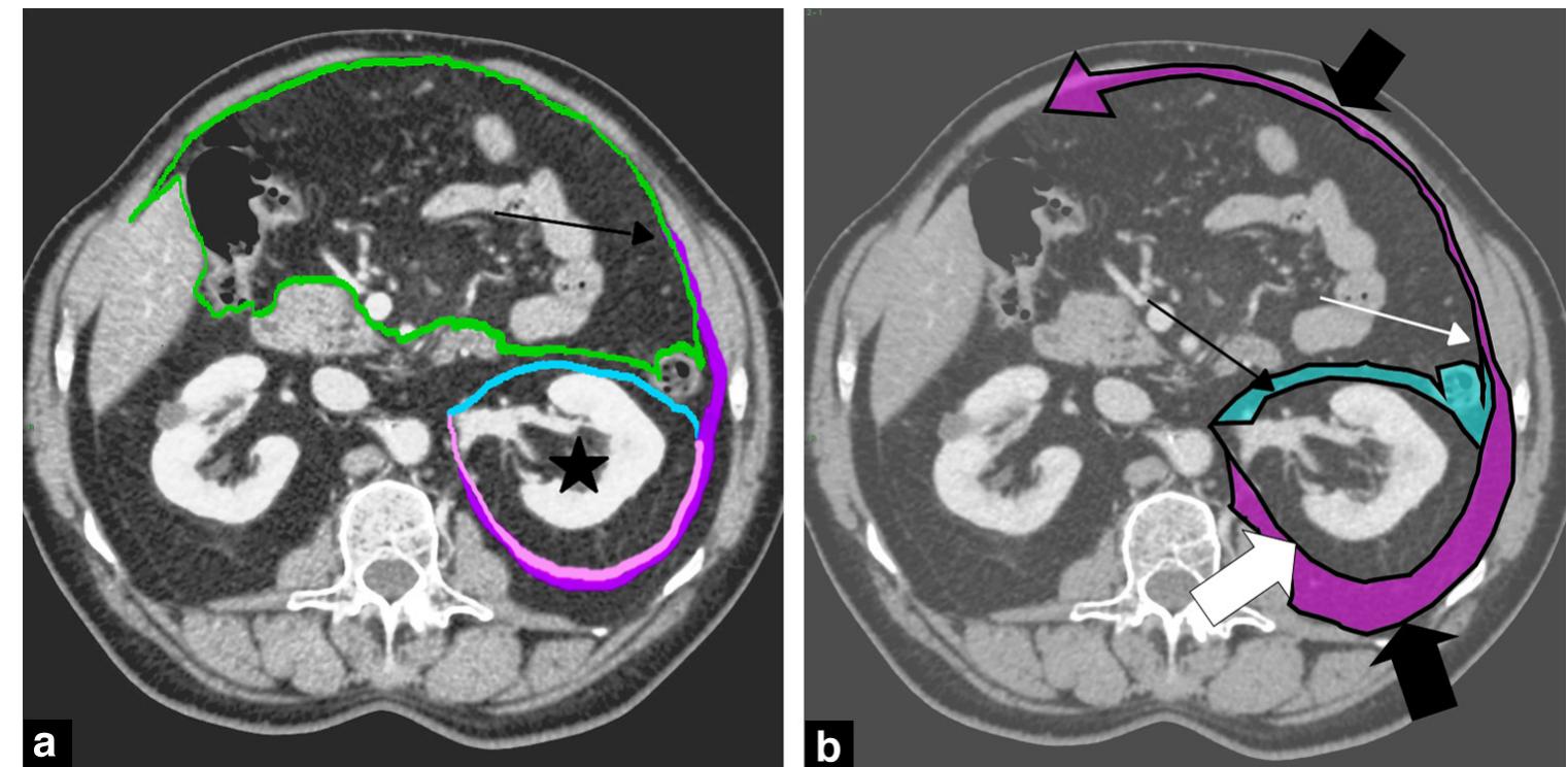 Posterior renal fascia. a: axial ct view at the left renal
