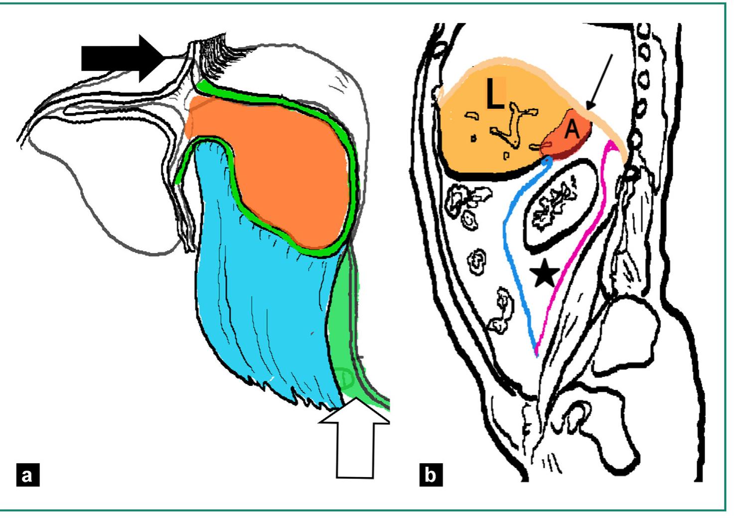 Bare area of the liver. a: diagram of a posterior view of