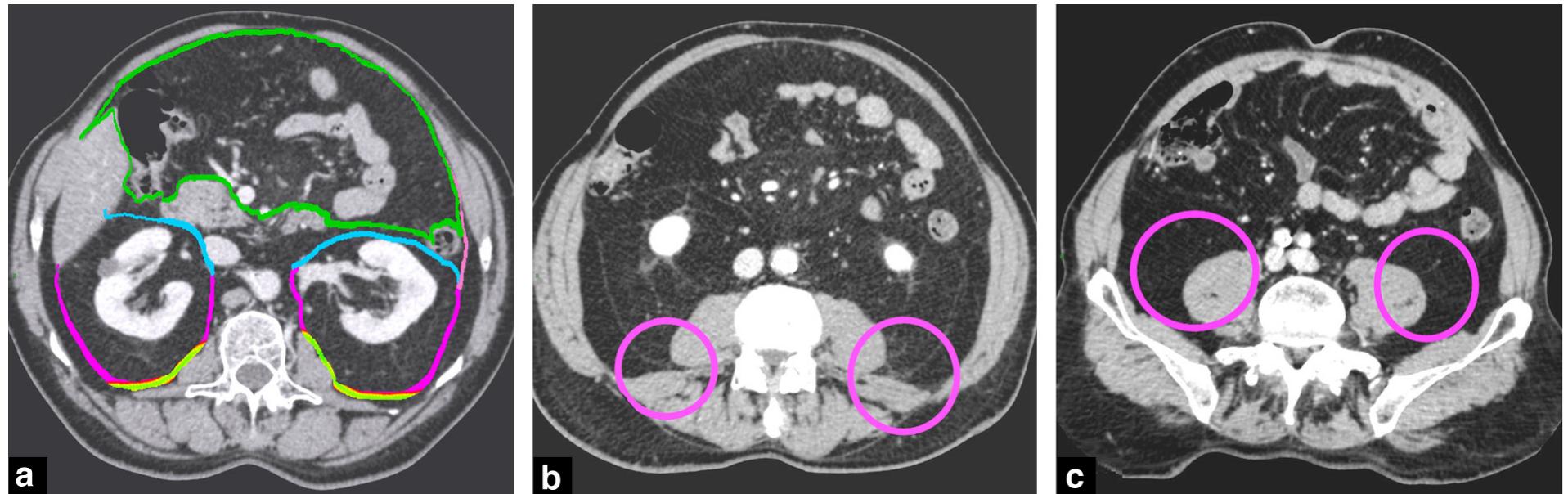 Medial border of the fasciae. a: axial ct view through the