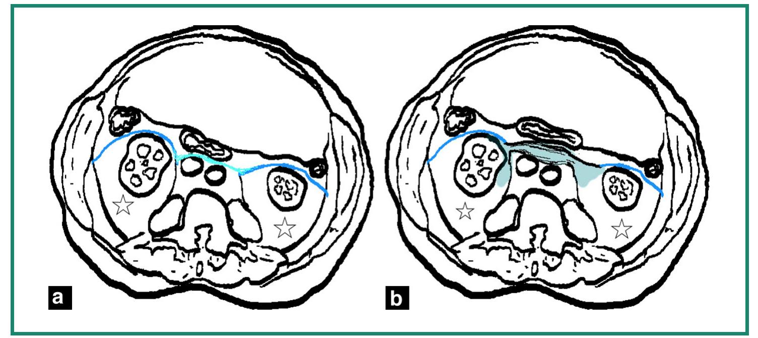 Medial extension of the arf. a: diagram of an axial
