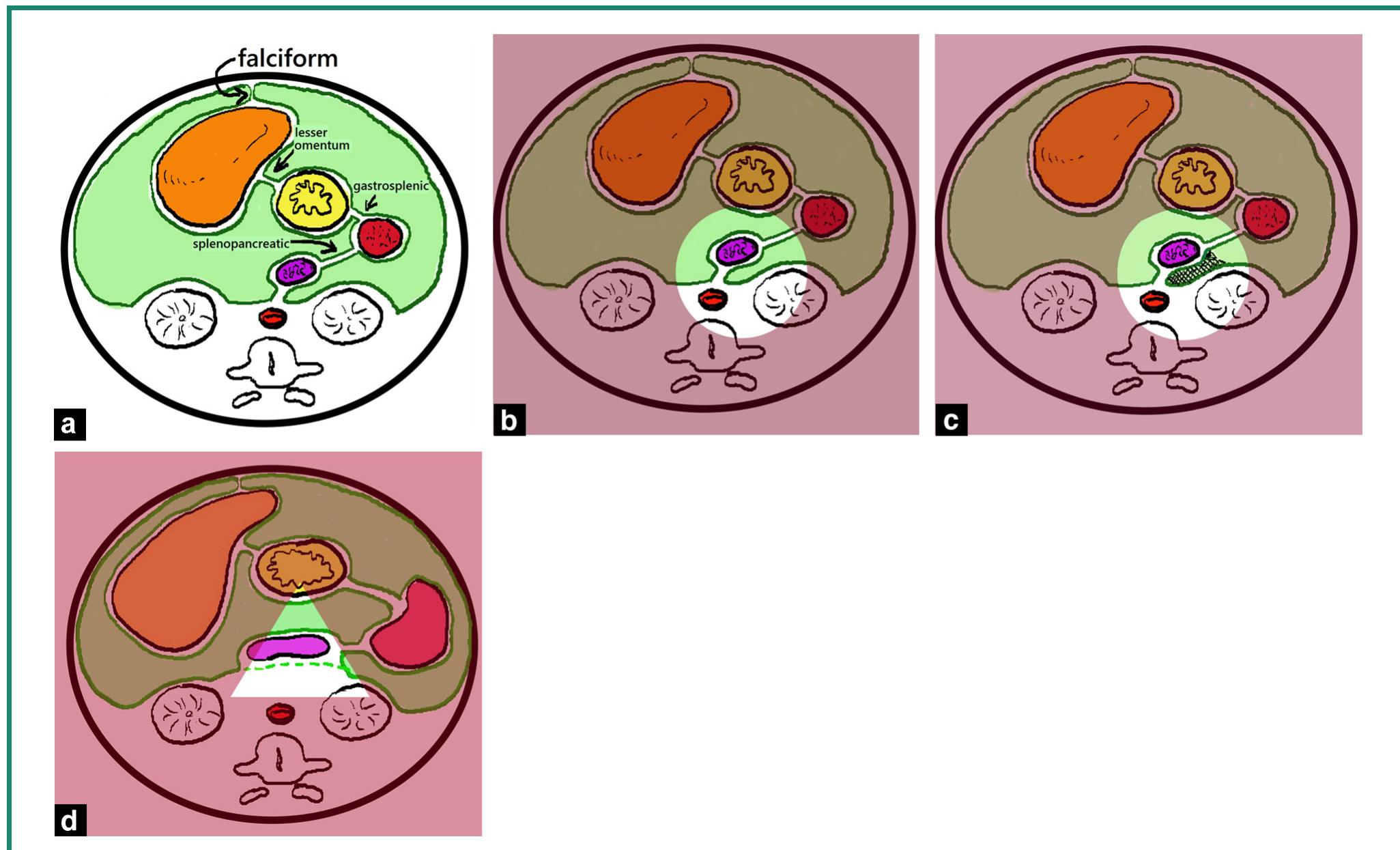Diagram of retropancreatic and peritoneal fusion. a) axial