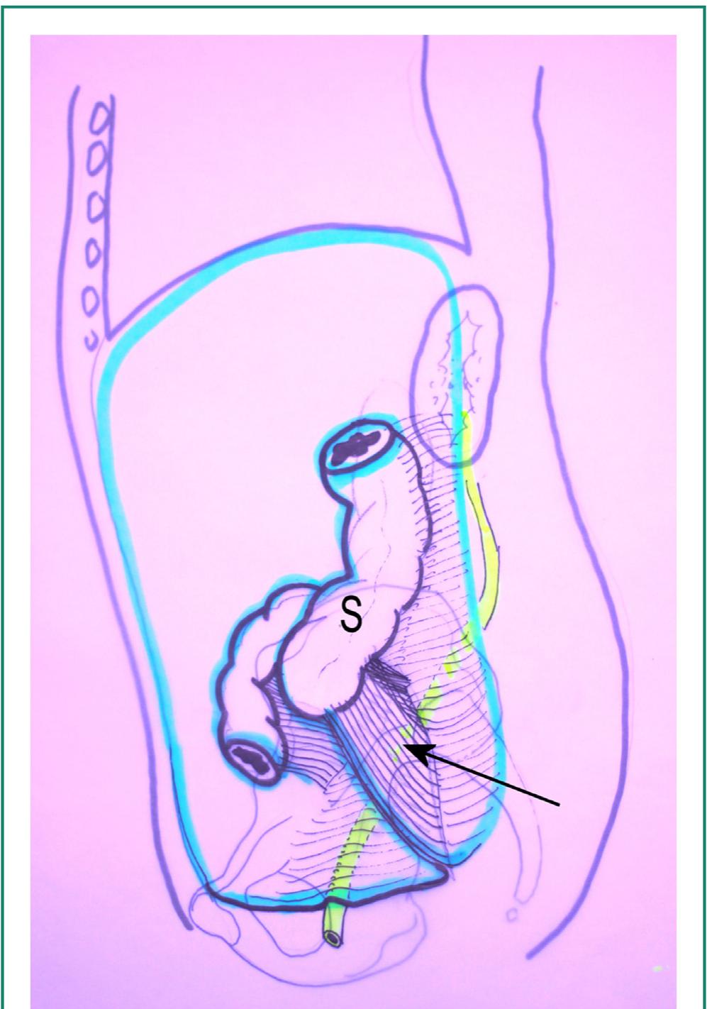 Figure 23 - Radioanatomy of the retroperitoneal space