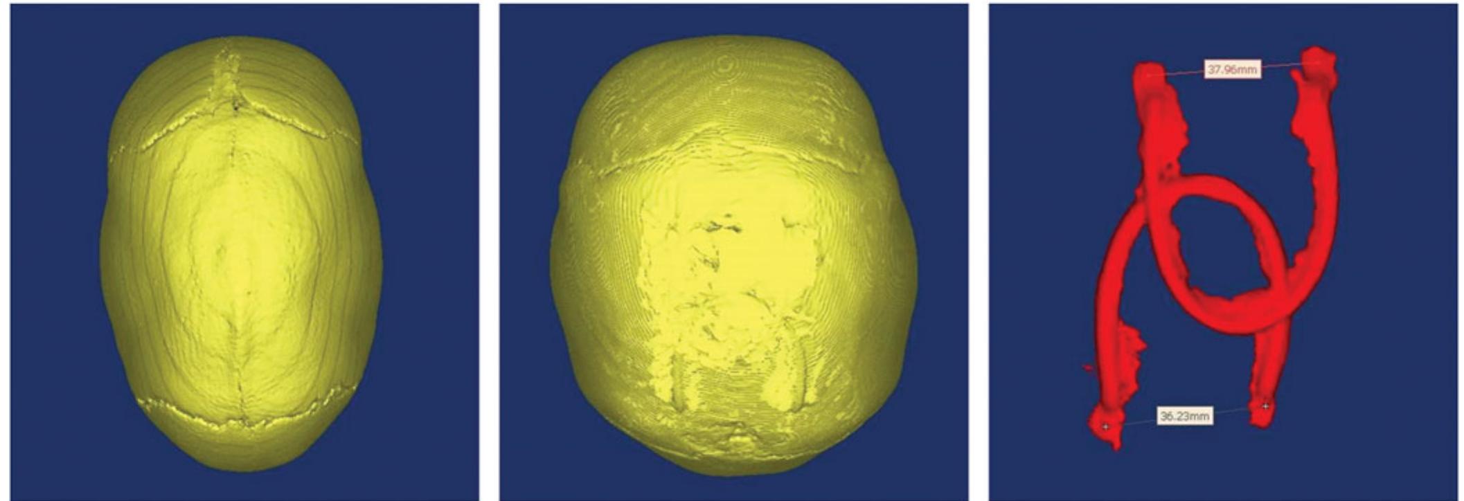 3d reconstruction of a skull with sagittal synostosis and