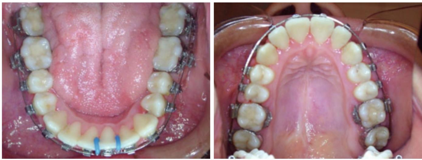 S. 2.42 and 2.43 progress mandibular and maxillary intraoral