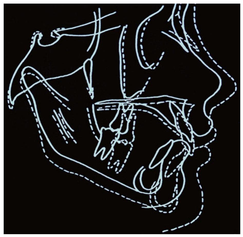 Both maxillary and mandibular cephalometric superimpositions