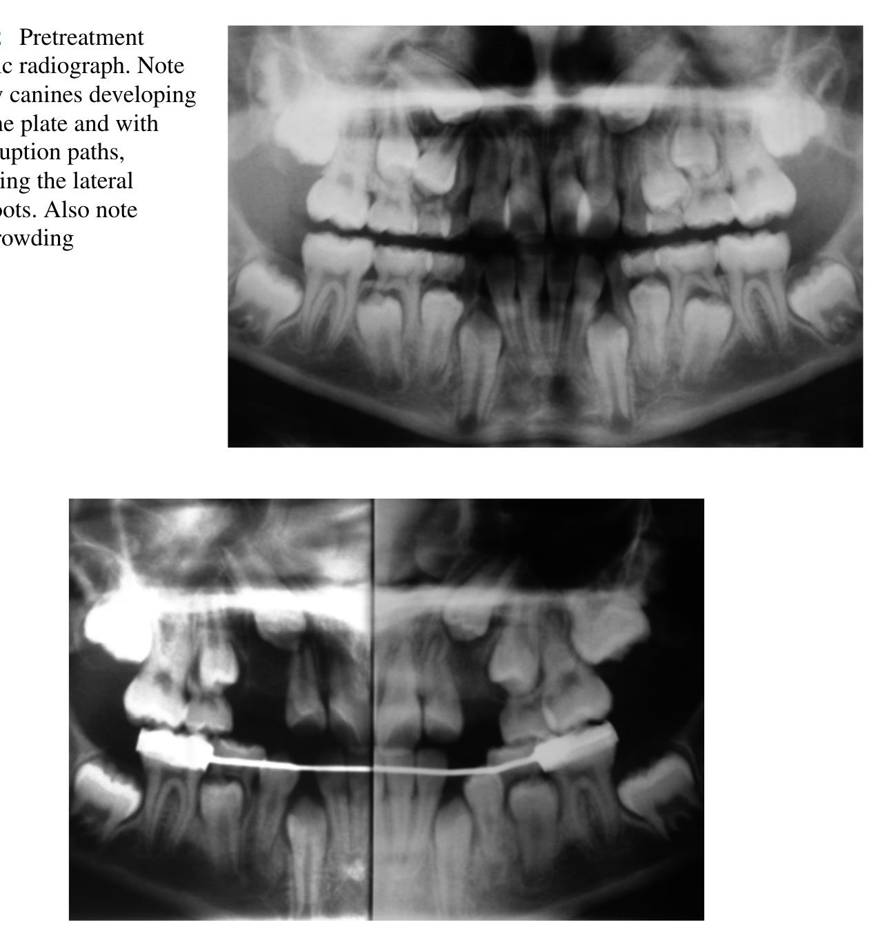 53 progress panoramic radiograph taken at age 10.5. note