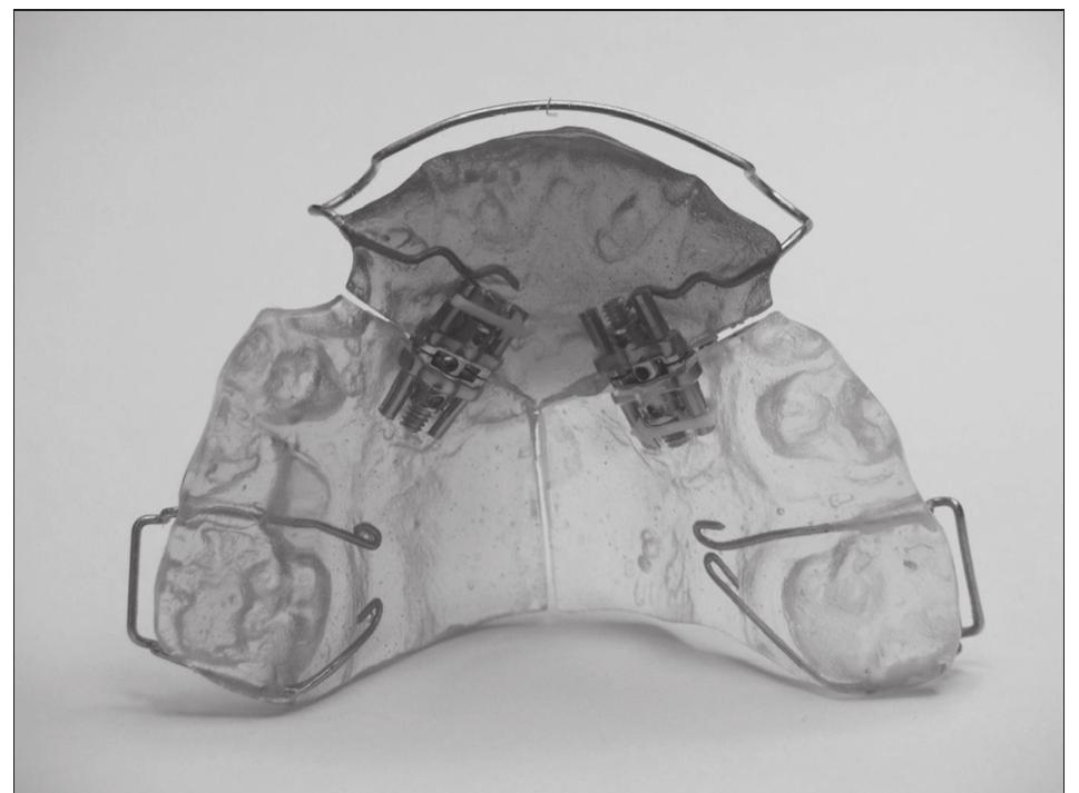 The “y” appliance