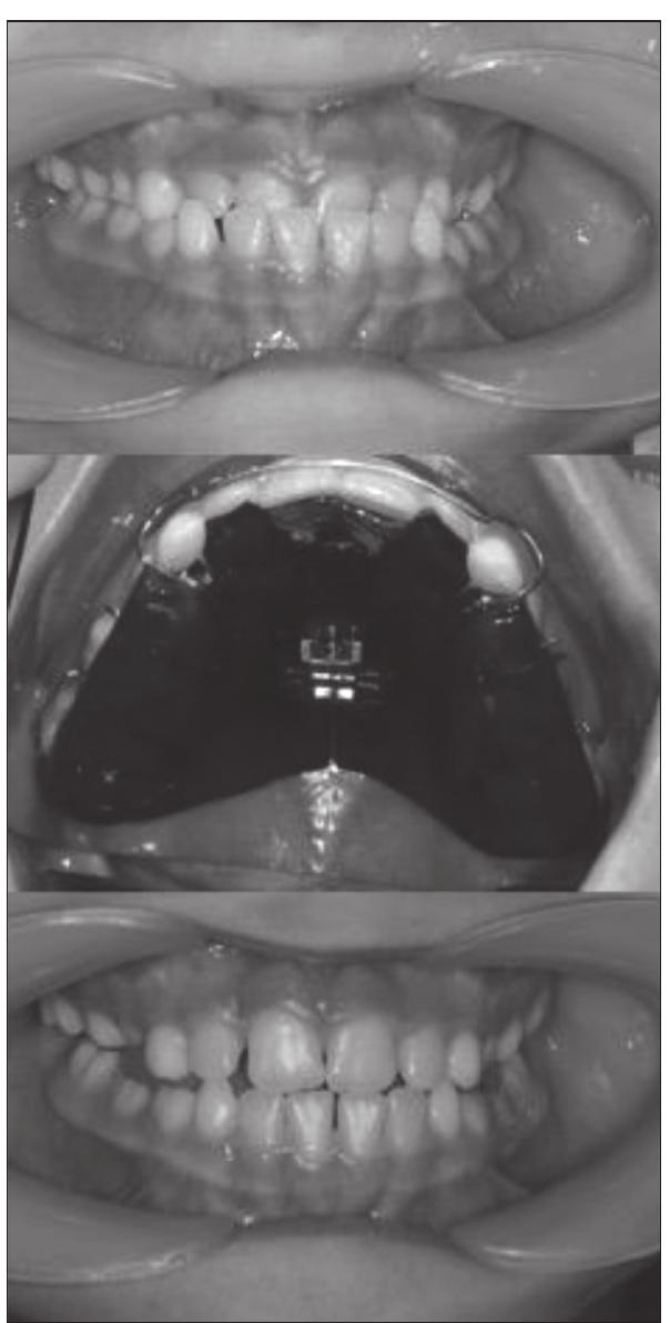 Figure 4 - Changes during treatment of class III