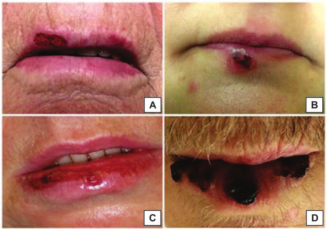 | mainly reversible types of cheilitis (a = cheilitis