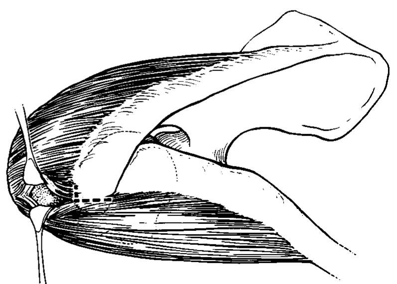 Illustration showing the split in the deltoid raphe being