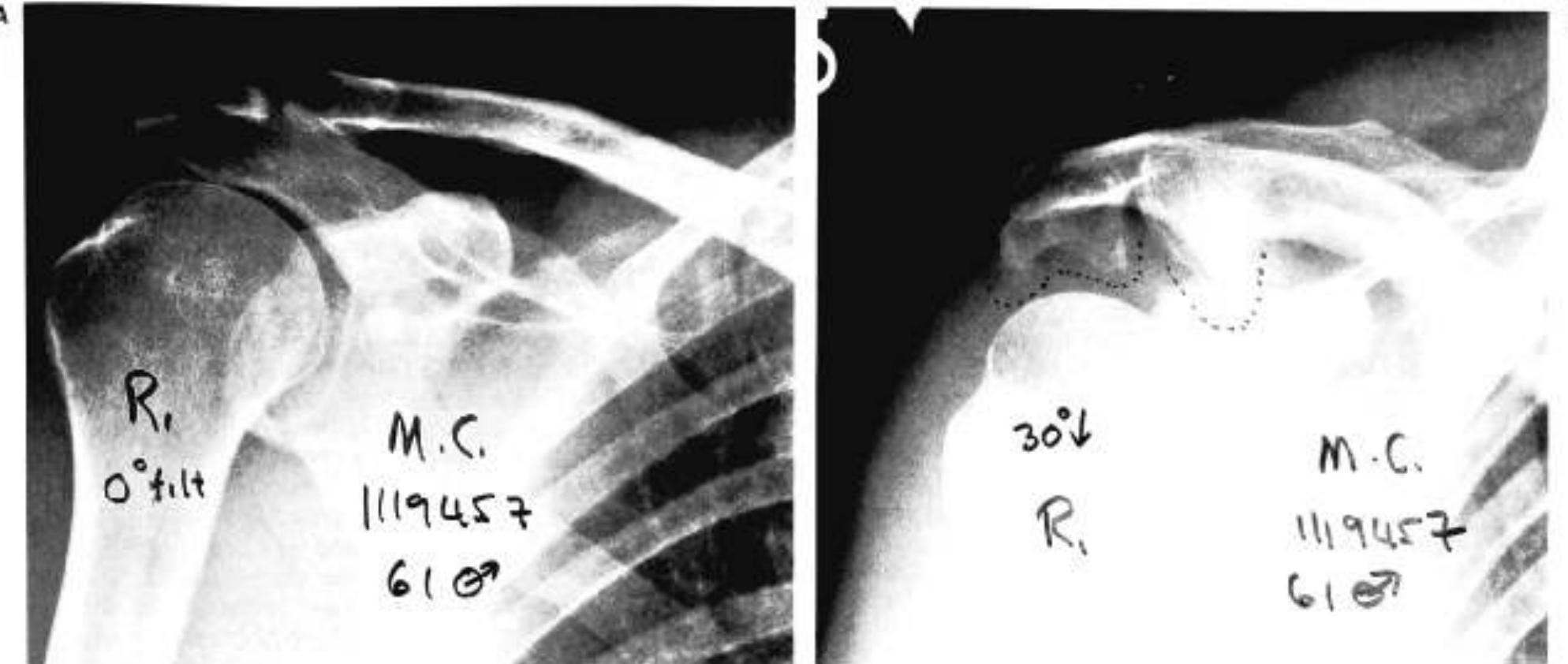 Comparison of an anterior-posterior radiograph to a 30°