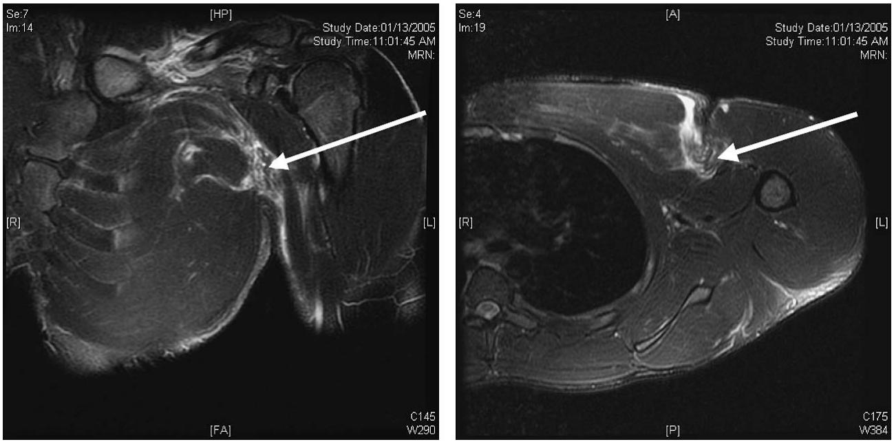 Figure 5 - Pectoralis Major Tendon Ruptures: Diagnosis and