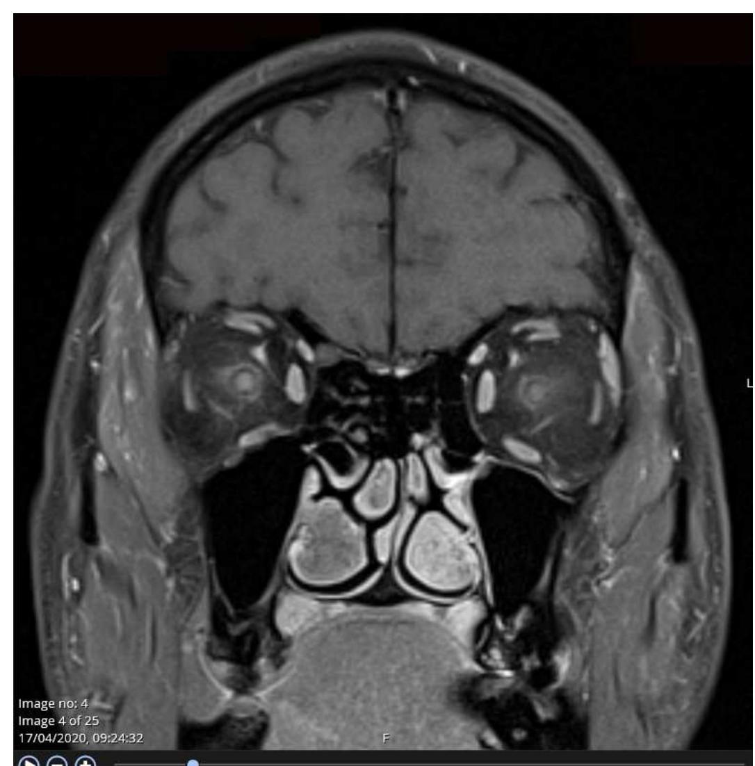 Figure 28 - Diagnosis and classification of optic neuritis