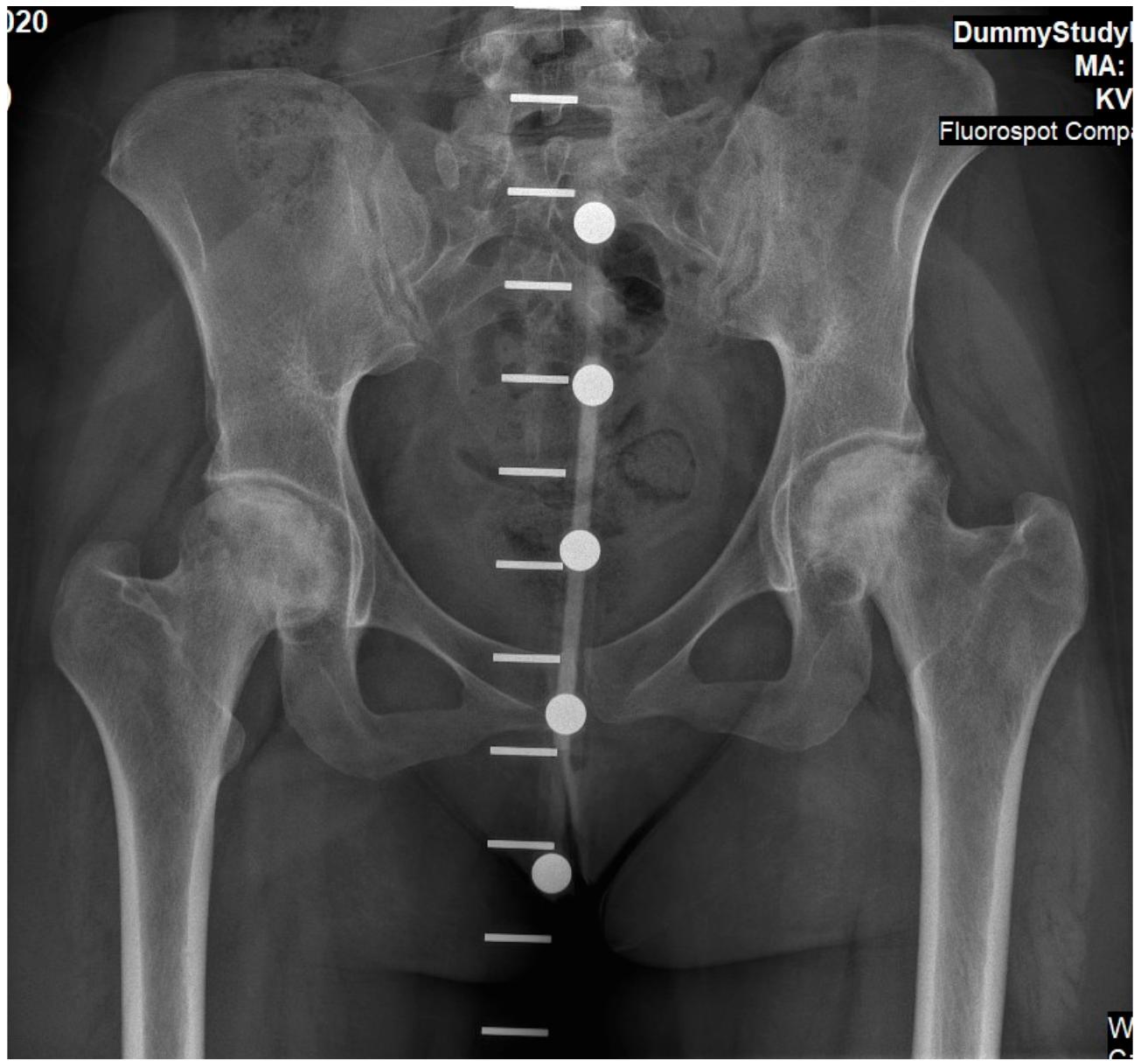 An antero-posterior x-ray of pelvis and hip joints of case