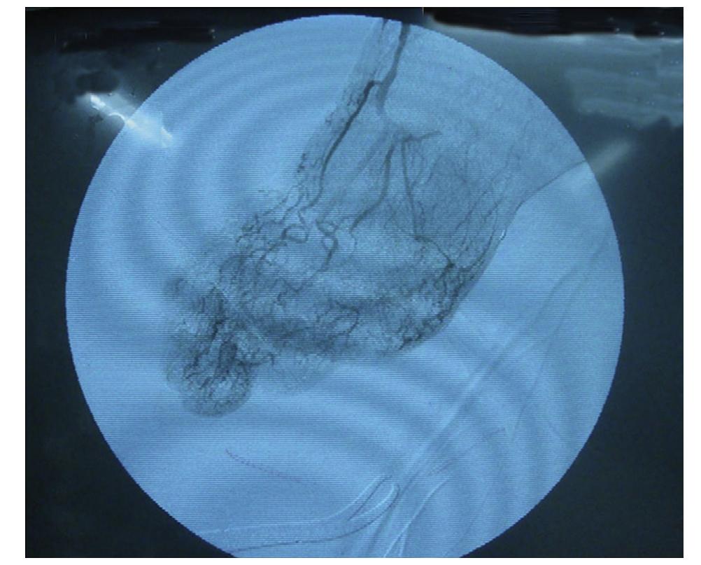 Completion arteriography from the femoral artery showing the