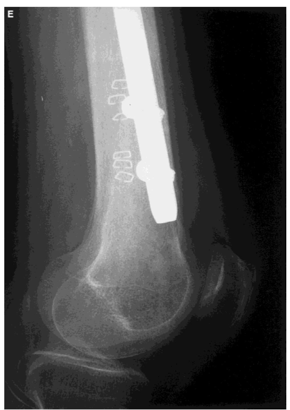Anterior cortical penetration. anteroposterior radiographs