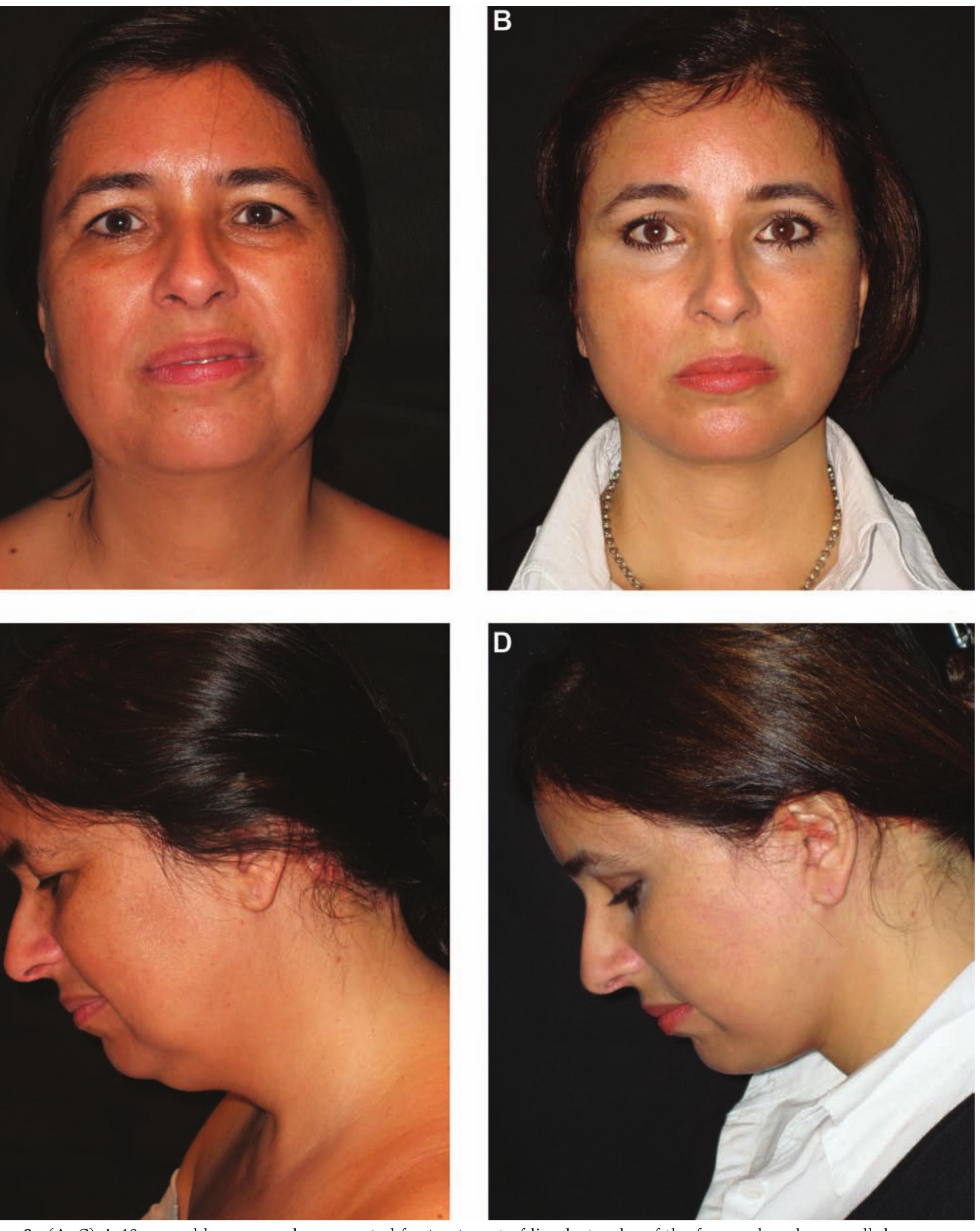 Figure 8 - Triple Suture for Neck Contouring: 14 Years of