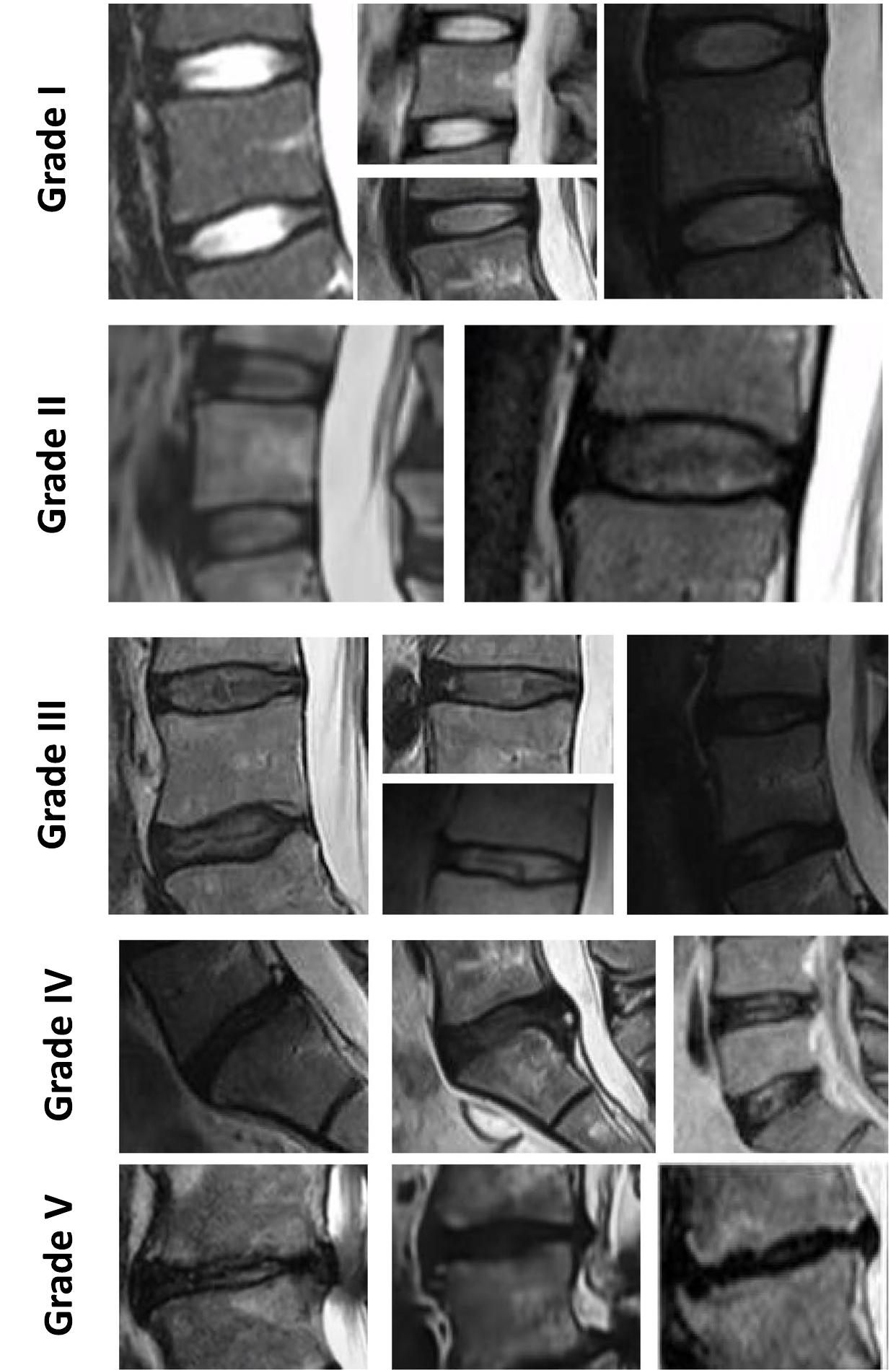 Grading of lumbar disc degeneration according to pfirrmann