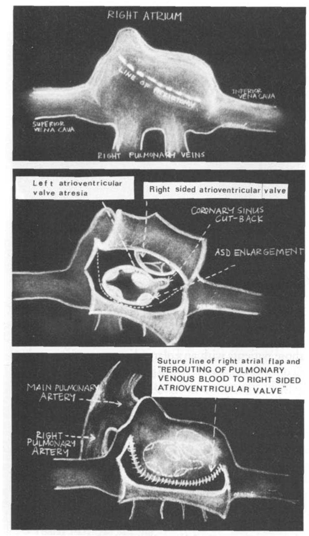 (top) right atriotomy incision shown from the viewpoint of