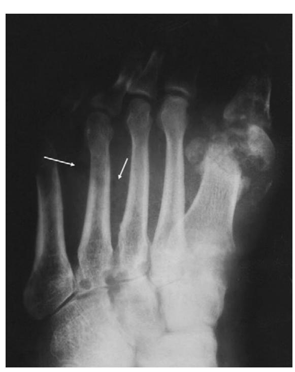 Secondary to a contiguous focus of infection. the latter may
