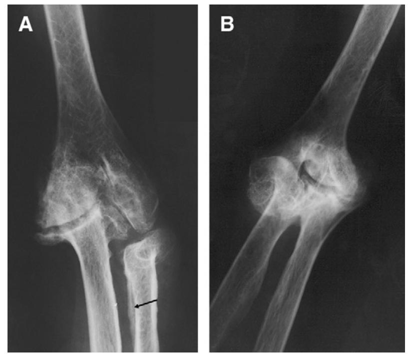 Variola (smallpox) osteomyelitis and septic arthritis. ap