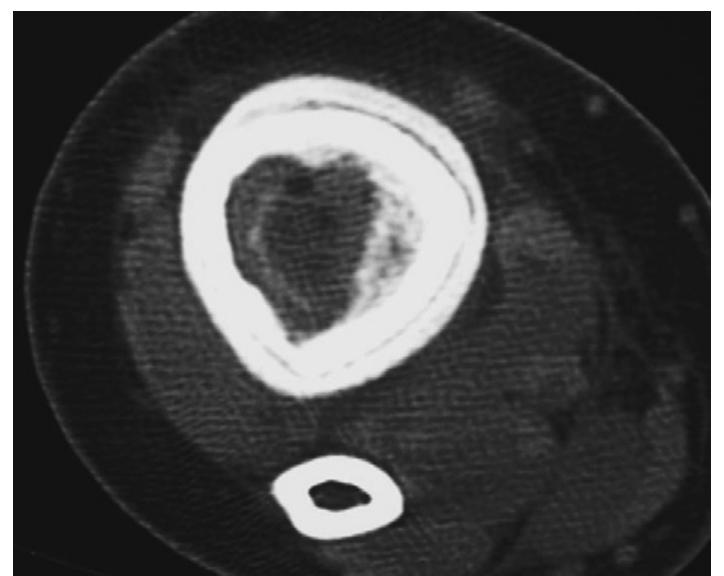 Infective periostitis. transaxial ct scan of the tibia and