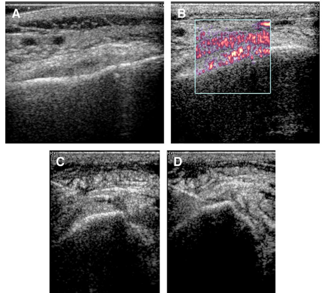 S aureus periosteal abscess. (a) longitudinal us scan. (b)