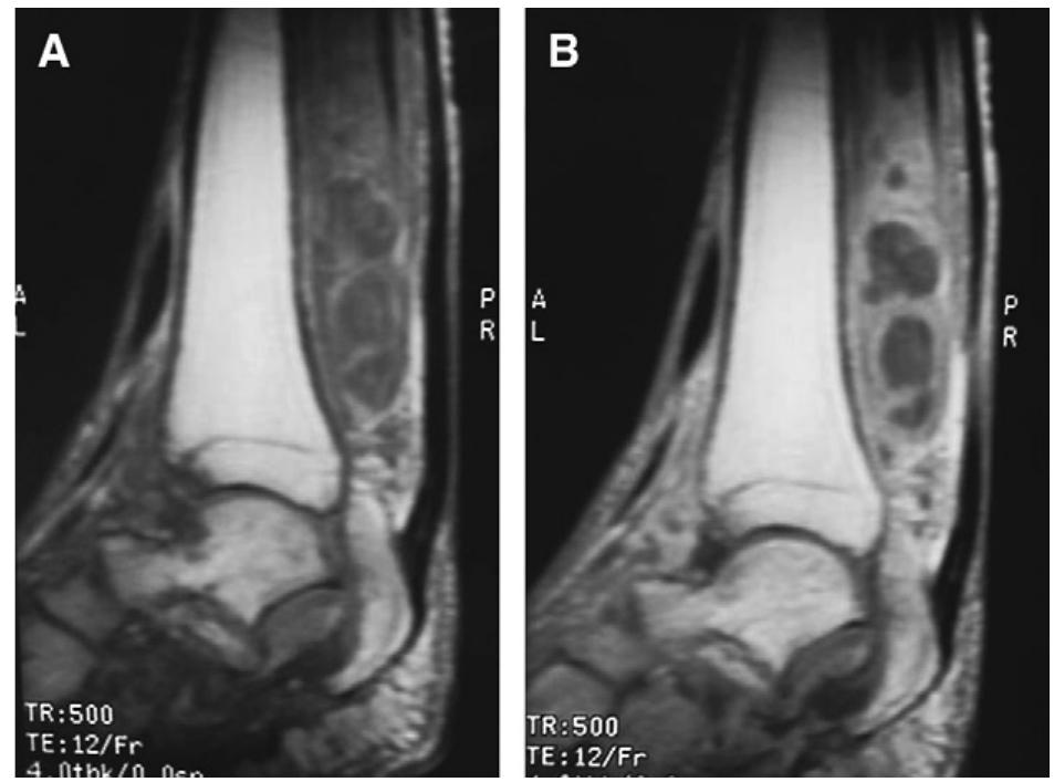 (a) sagittal tl-weighted mri (tr/te, 500/12) shows a soft