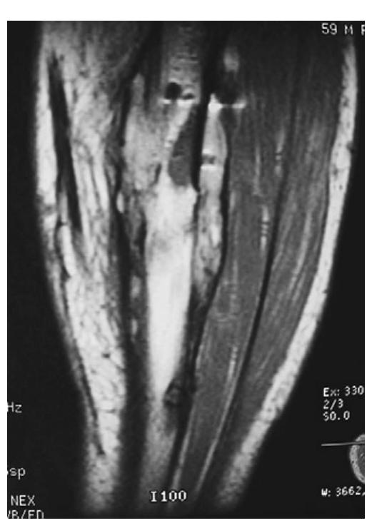 Chronic active osteomyelitis mri. coronal t1-weighted image