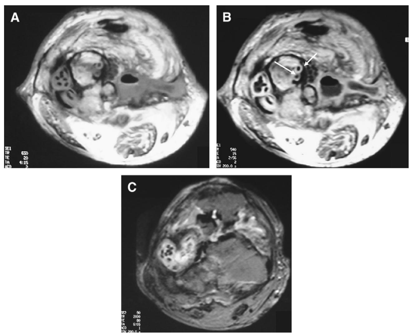 Mri of chronic osteomyelitis of the femur in a patient who