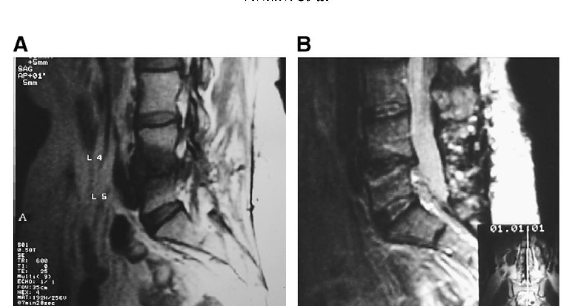Spinal infection. (a) sagittal t1-weighted (tr/te 600/25)