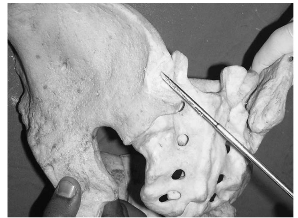 Bone model: entry point for the superior iliac screw— at the