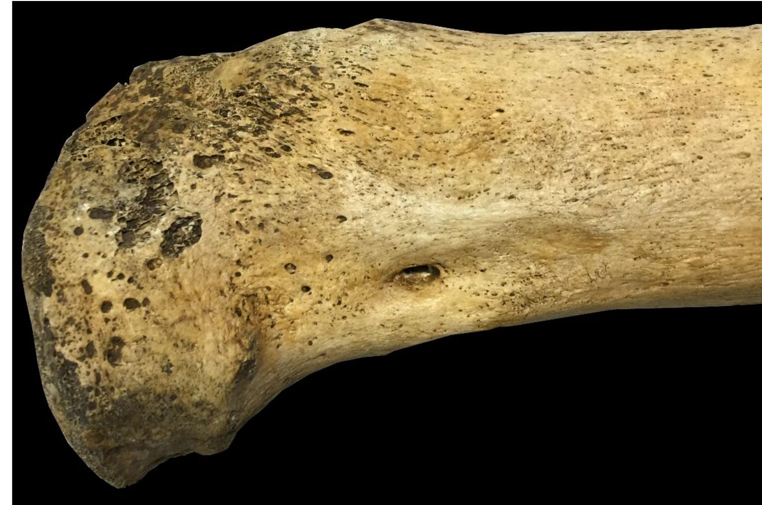 16 this image shows the cloaca caused by the osteomyelitis