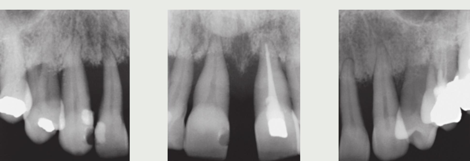 "igs 41 to 43 periapical radiographs of the maxillary