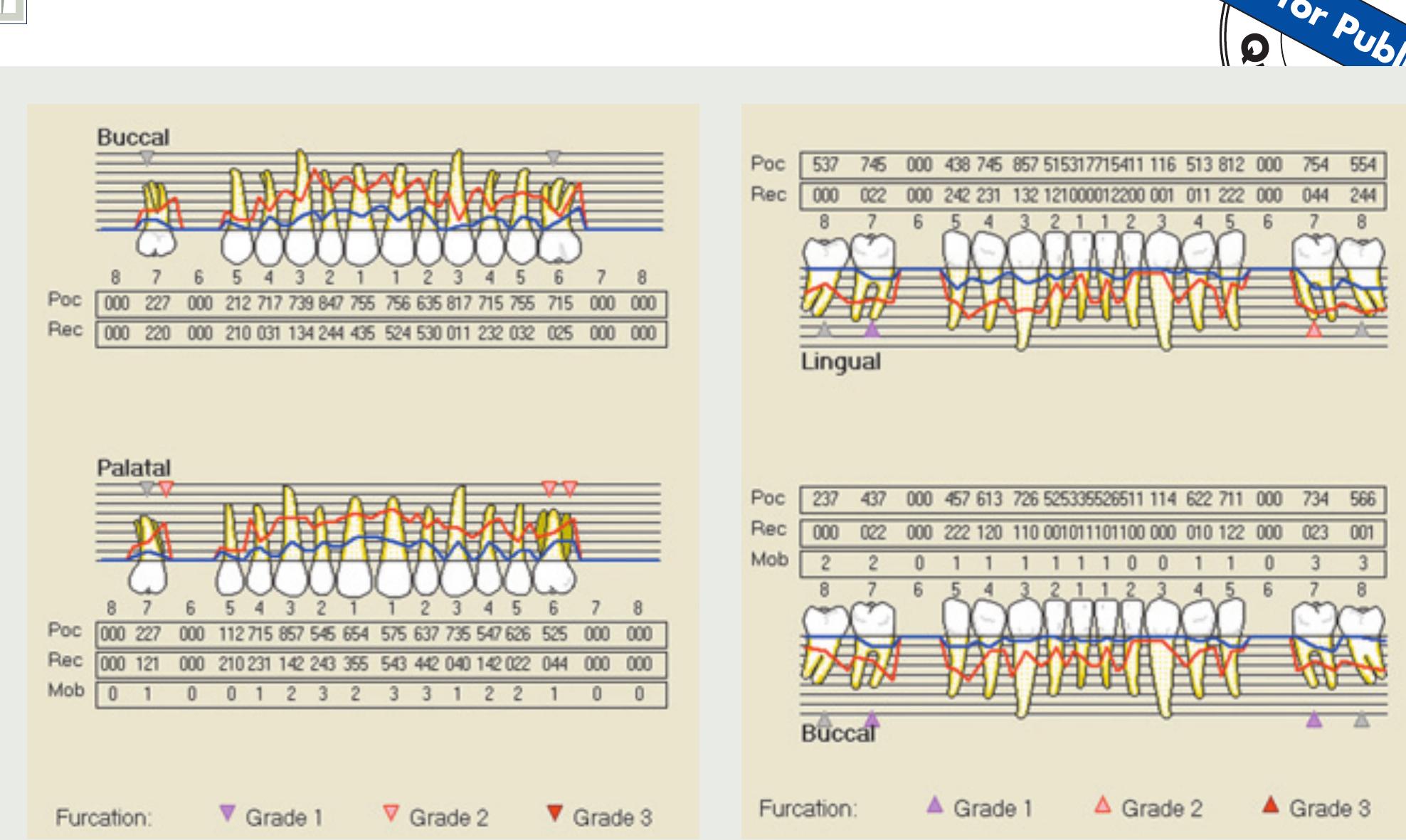 Periodontal chart of mandibular teeth. fig 44 periodontal