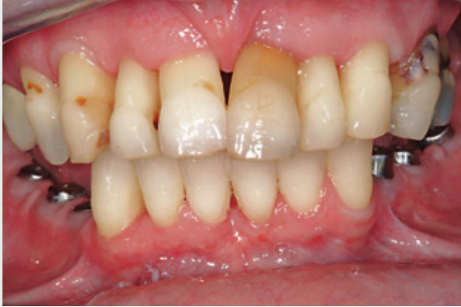 Final results of extrusion in the maxillary arch and