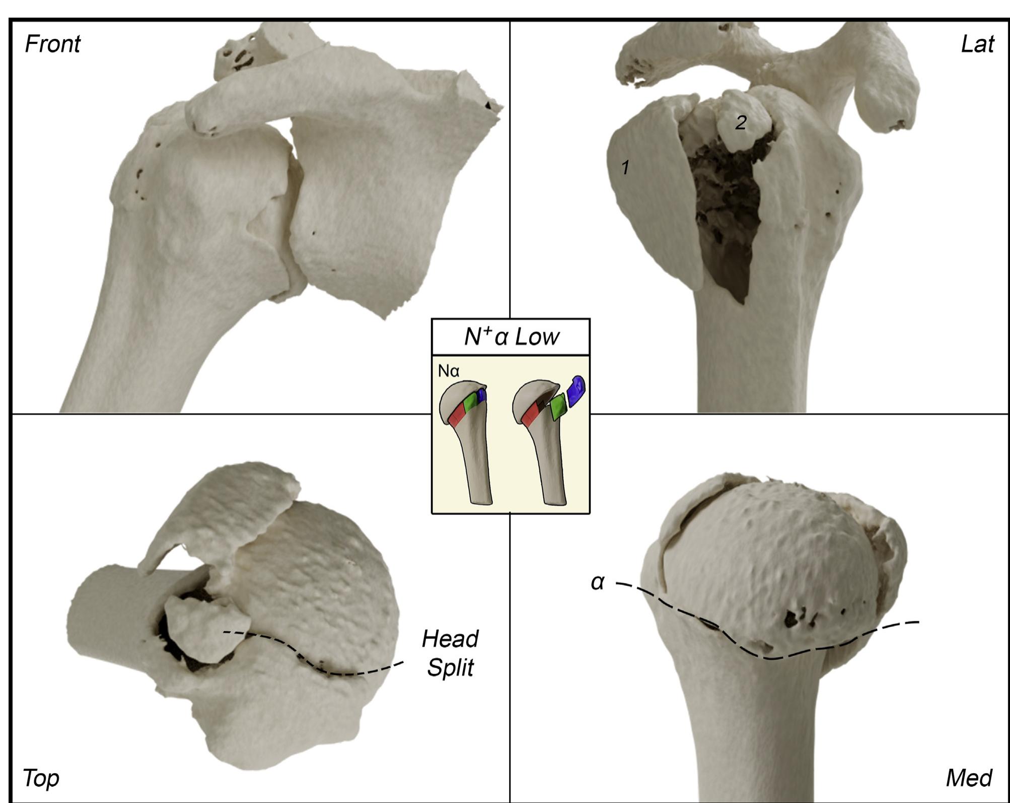 The impacted proximal humeral fractures classification