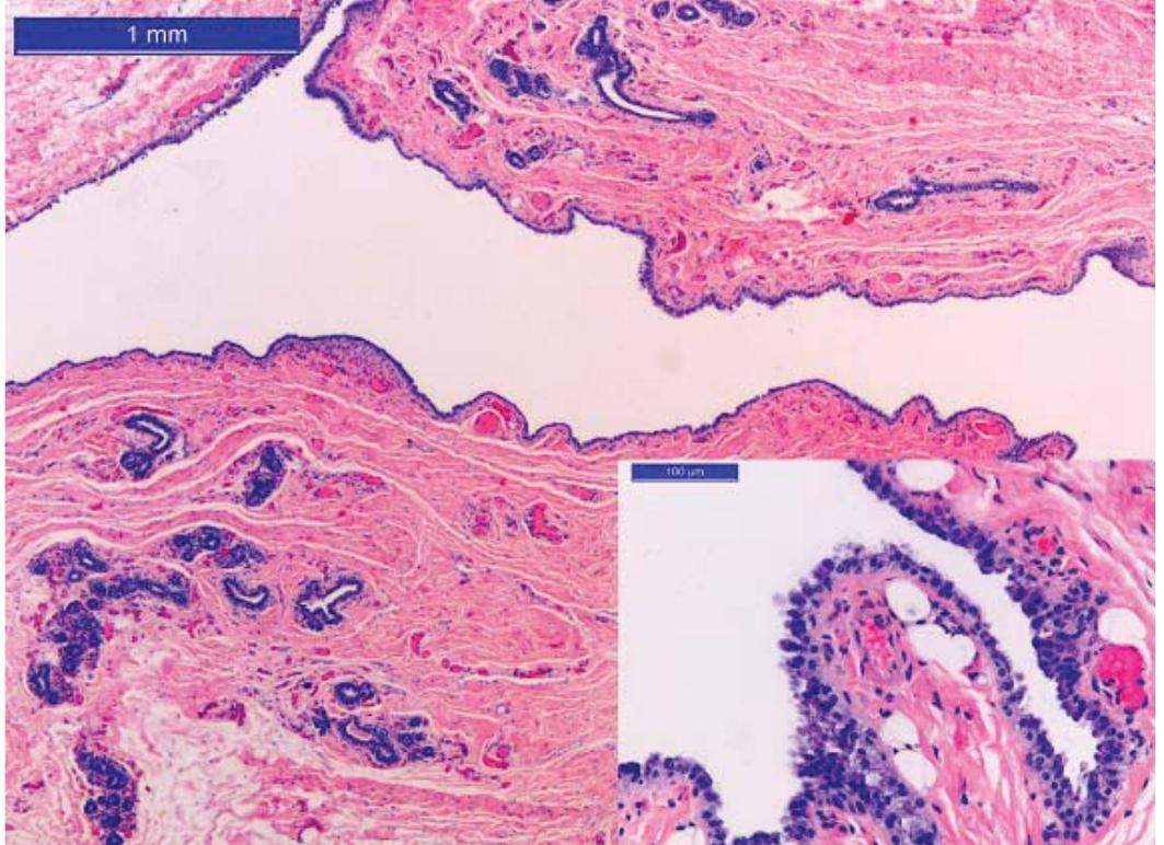histopathology of galactocele with a poorly ‘defined, thin