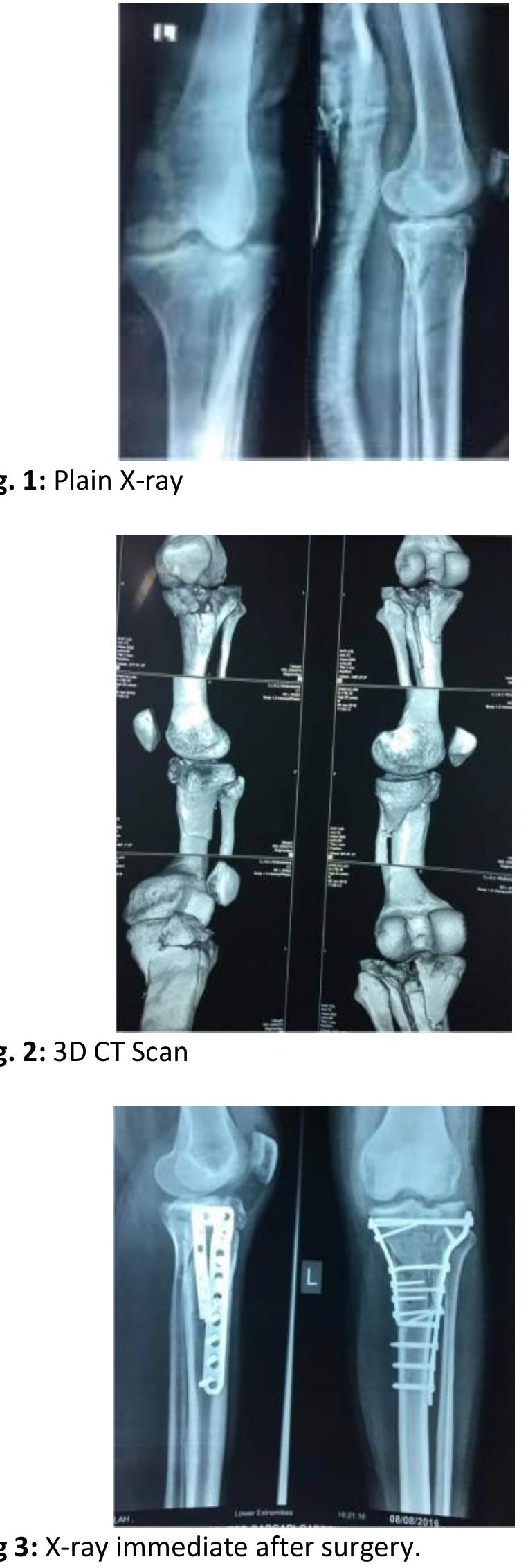 To 5: schatzker type vi fracture in 23 year old man treated